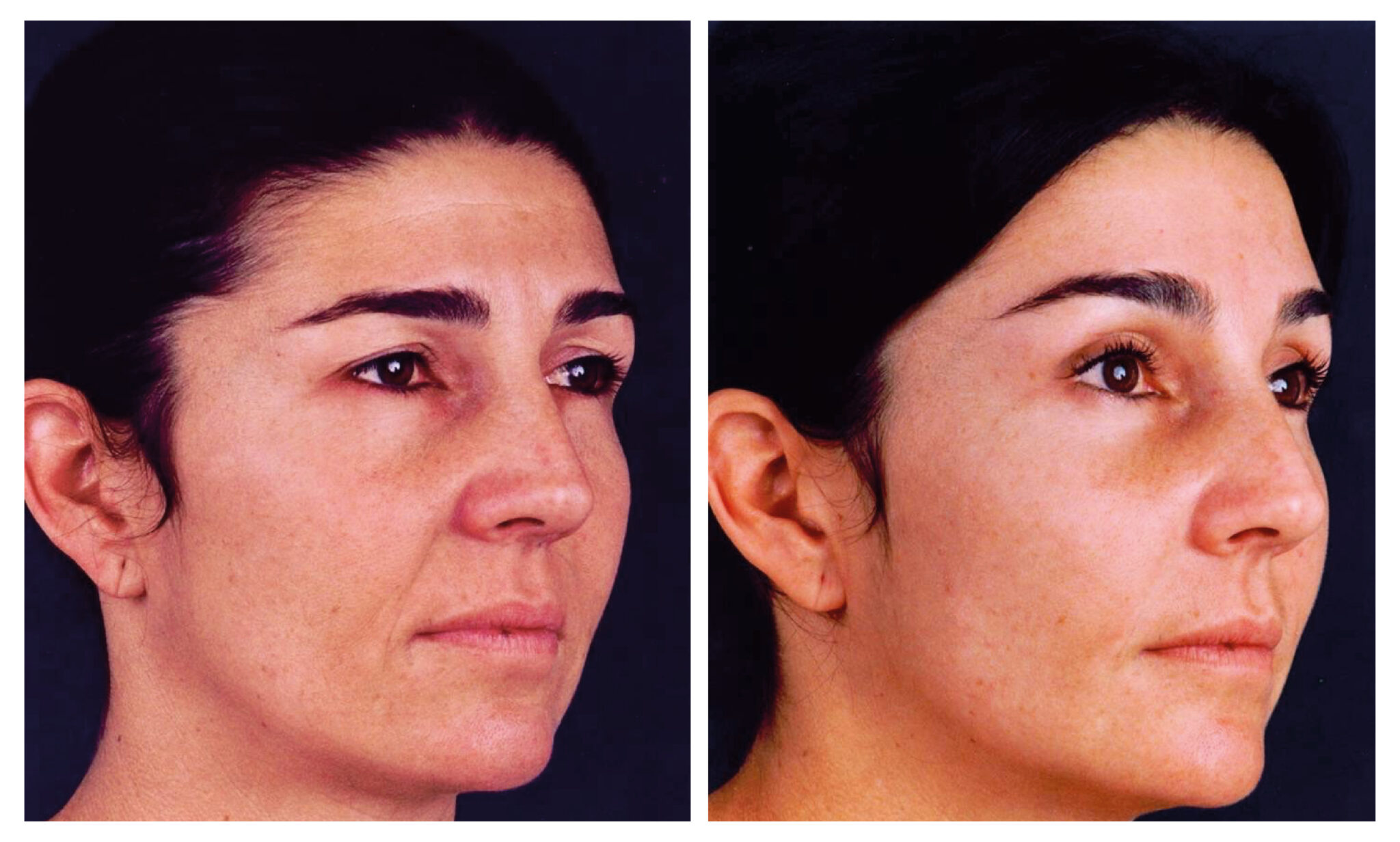 Estiramiento o Lifting Facial Endoscópico